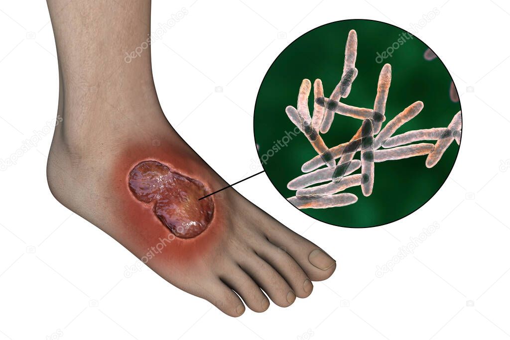 Úlcera de Buruli, una enfermedad debilitante crónica que afecta la piel ...