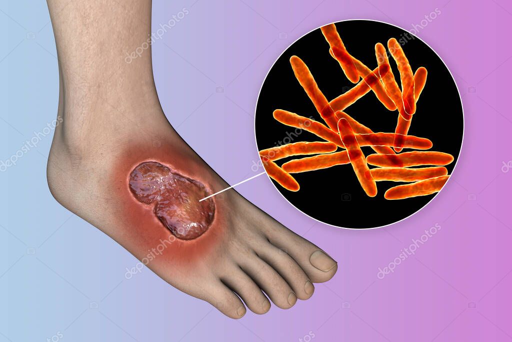 Buruli ulcer, a chronic debilitating disease affecting skin and ...