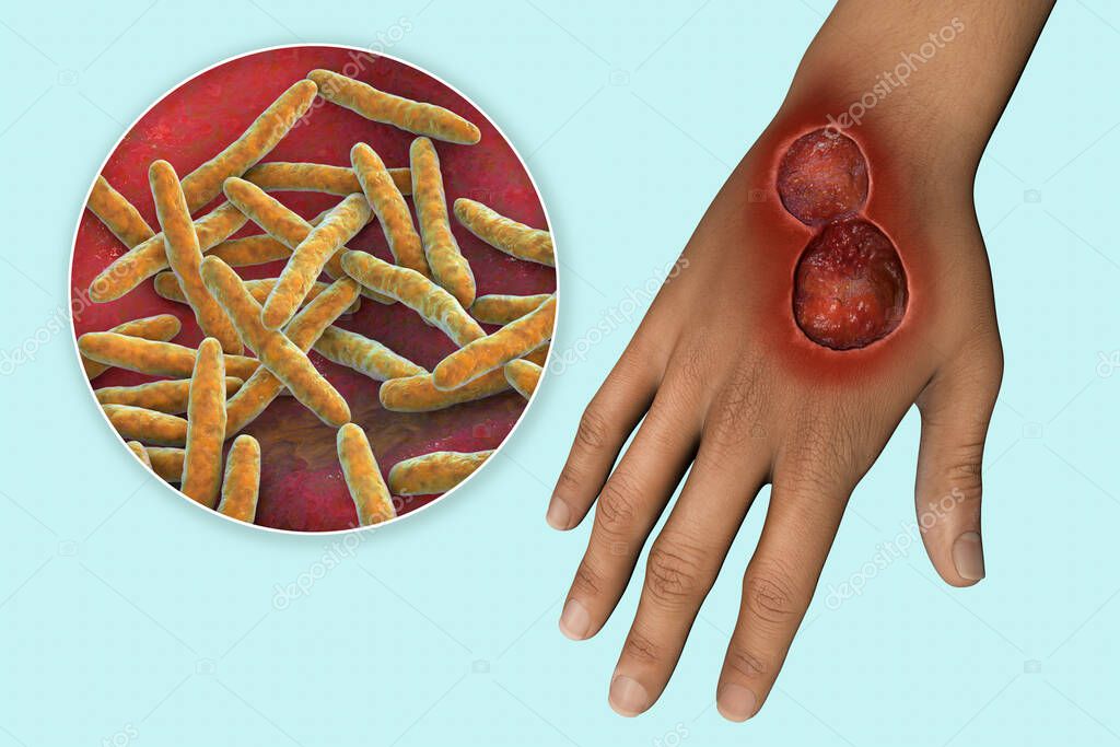 Buruli ulcer, a chronic debilitating disease affecting skin and ...