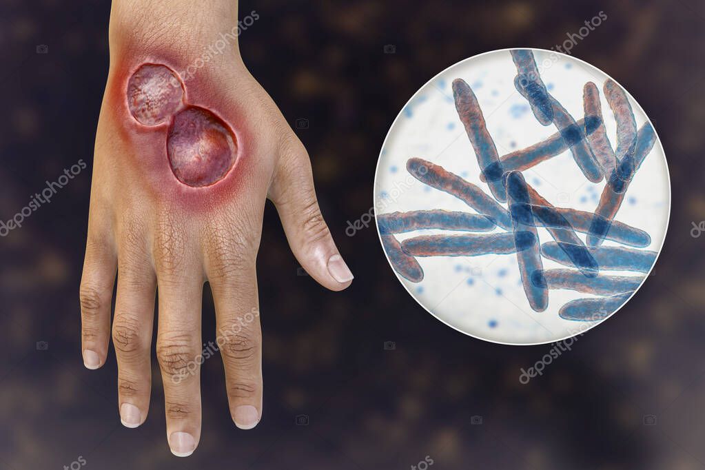 Úlcera de Buruli, una enfermedad debilitante crónica que afecta la piel ...