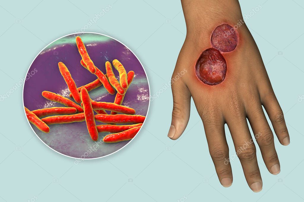 Buruli ulcer, a chronic debilitating disease affecting skin and ...