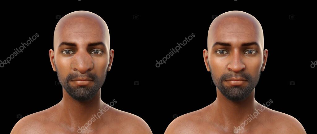 Conidiobolomicosis rinofacial en un hombre y la misma persona sana ...