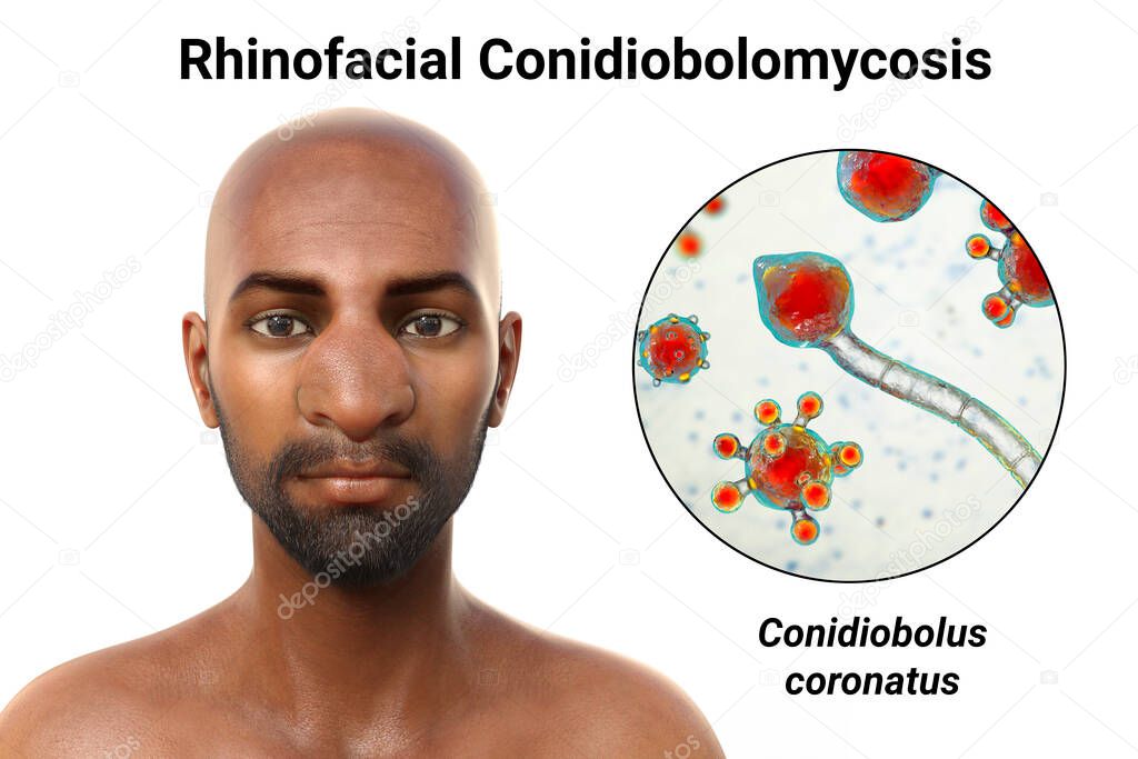 Conidiobolomicosis rinofacial en un hombre y hongos microscópicos ...