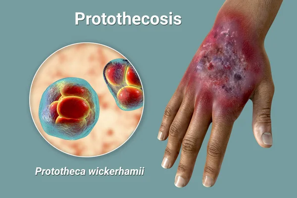Protothecosis infection on human hand and close-up view of Prototheca ...
