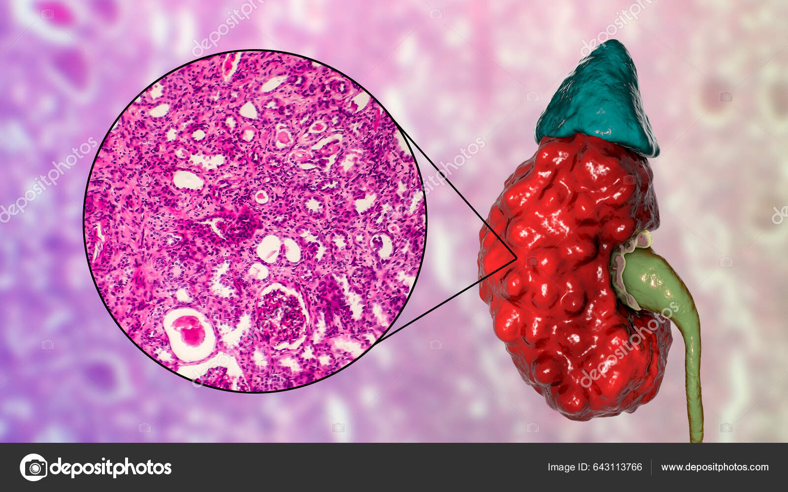 Pielonefritis Crónica Ilustración Que Muestra Morfología Macroscópica ...
