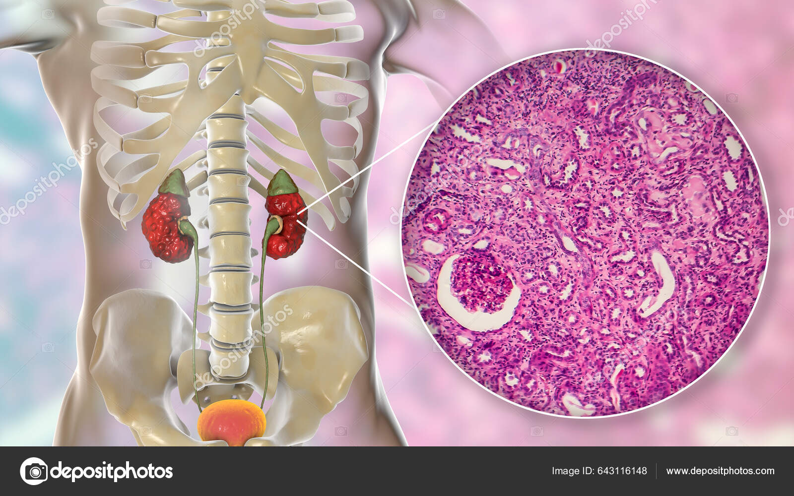 Chronic Pyelonephritis