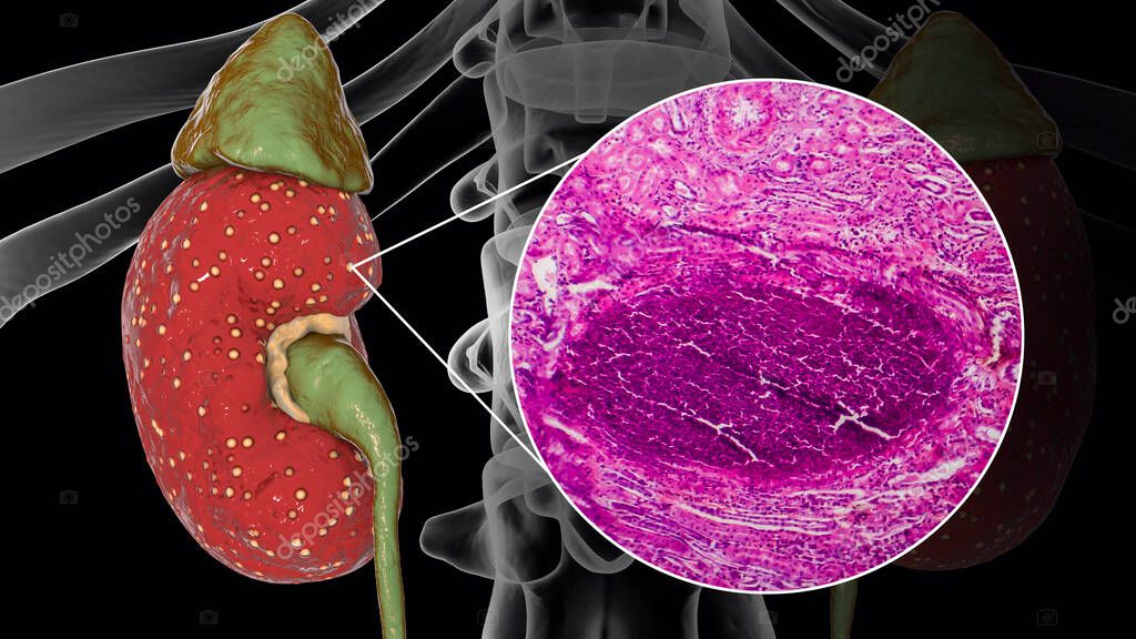 Acute Pyelonephritis Illustration Showing Gross Morphology Focal Small ...