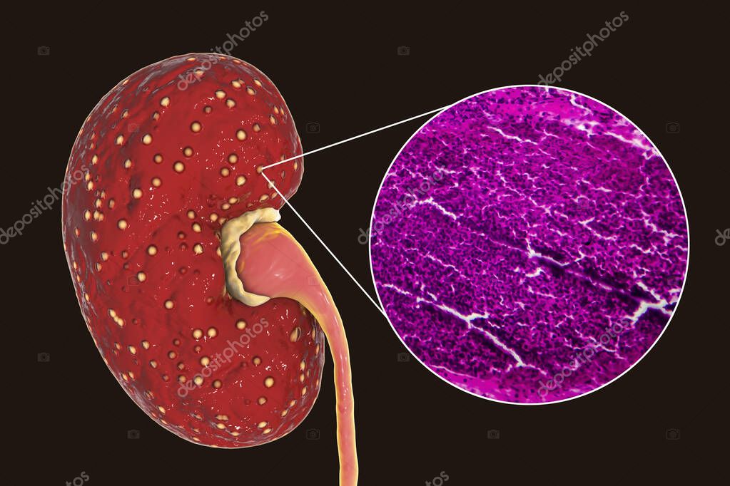 Pielonefritis aguda, ilustración 3D que muestra morfología macroscópica ...