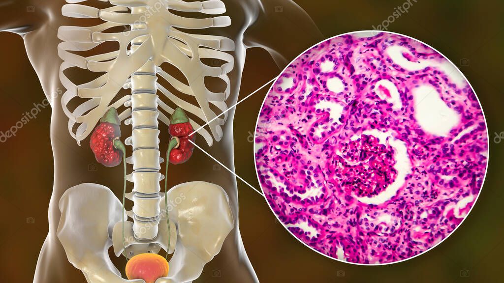 Pielonefritis crónica, ilustración 3D que muestra morfología ...