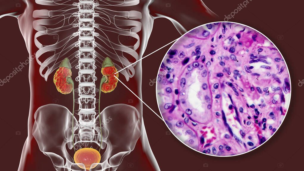 Chronic pyelonephritis, 3D illustration showing gross morphology with ...