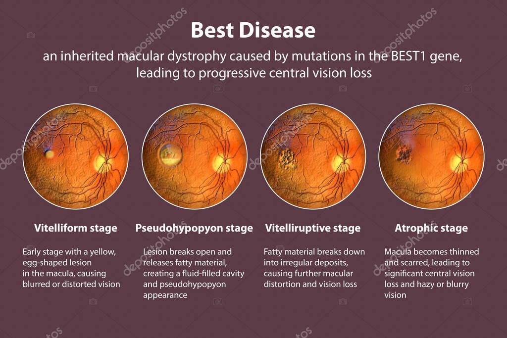 Etapas de la mejor enfermedad. Mejores etapas de distrofia macular ...