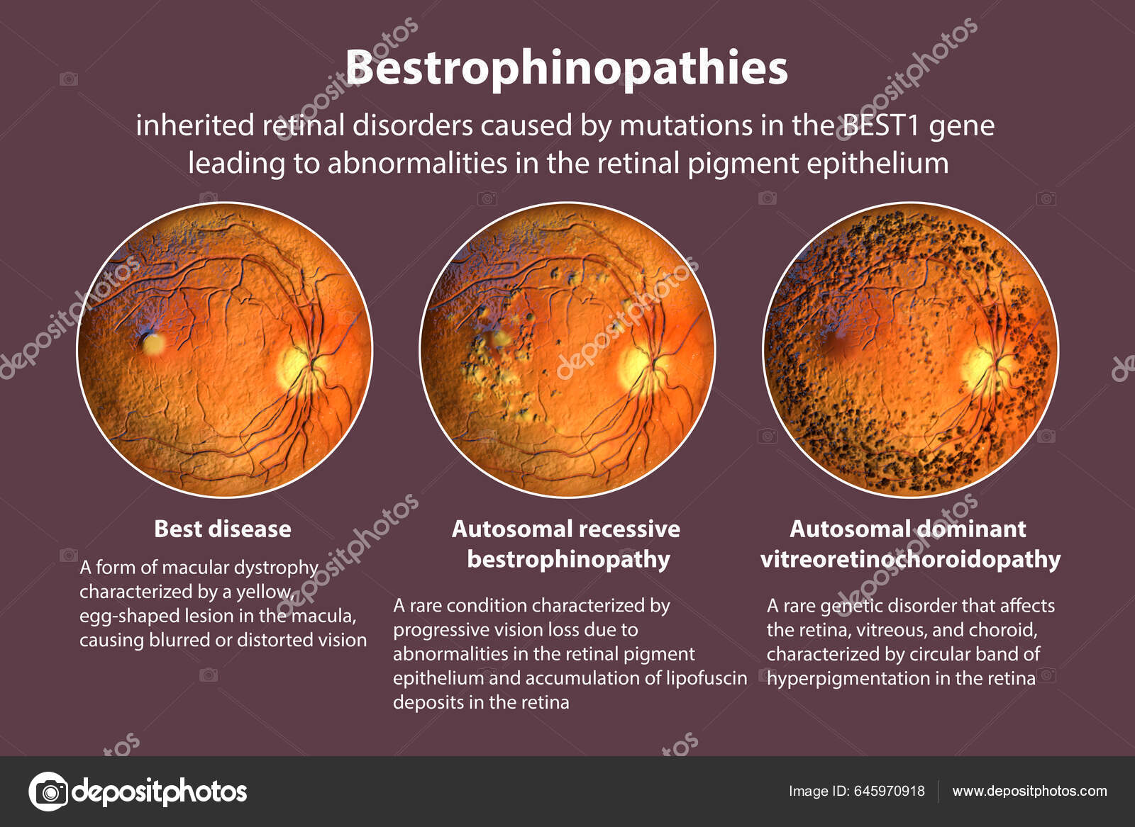 Bestrophinopathies Inherited Retinal Disorders Caused Mutations Best1