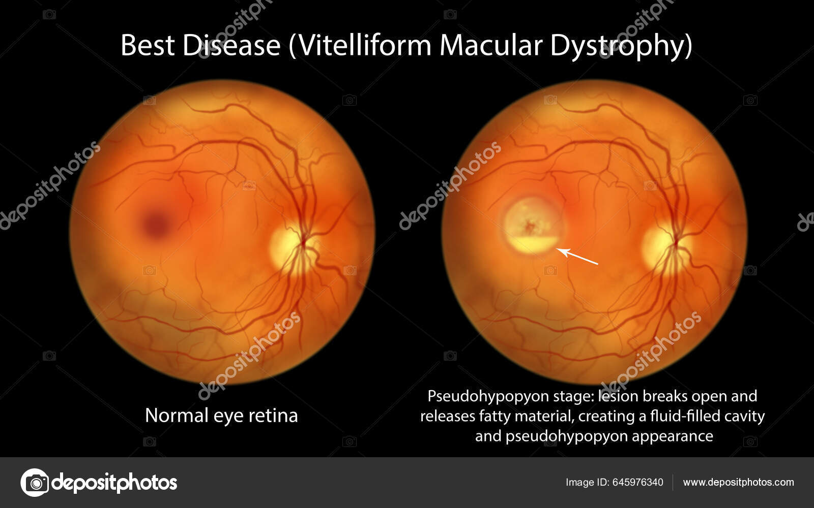 Best Disease Illustration Showing Normal Eye Retina Best Vitelliform ...