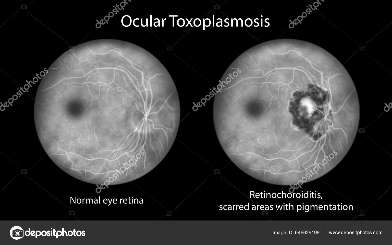 Toxoplasmose Retina