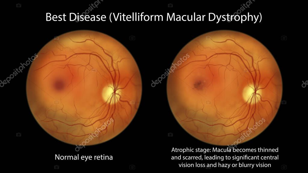 La mejor enfermedad, una ilustración que muestra retina ocular normal y ...