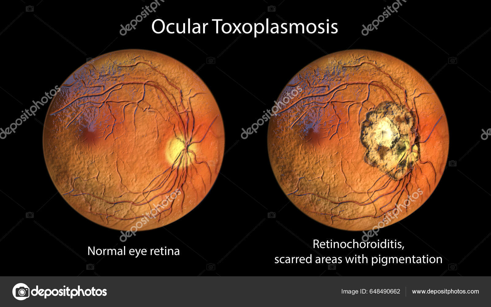 Toxoplasmosis Eye