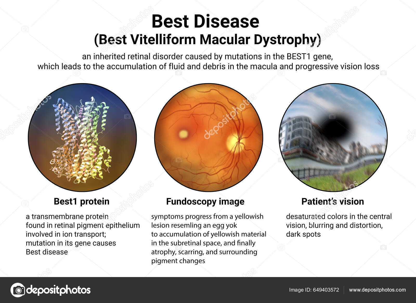 Best Disease Best Vitelliform Macular Dystrophy Illustration Showing ...