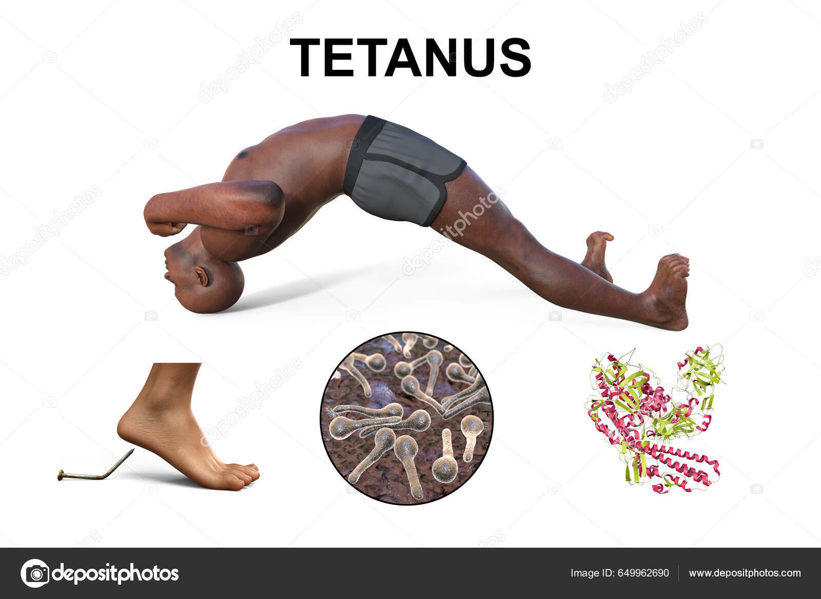 Enfermedad Del Tétanos Renderización Enfermedad Comienza Cuando ...
