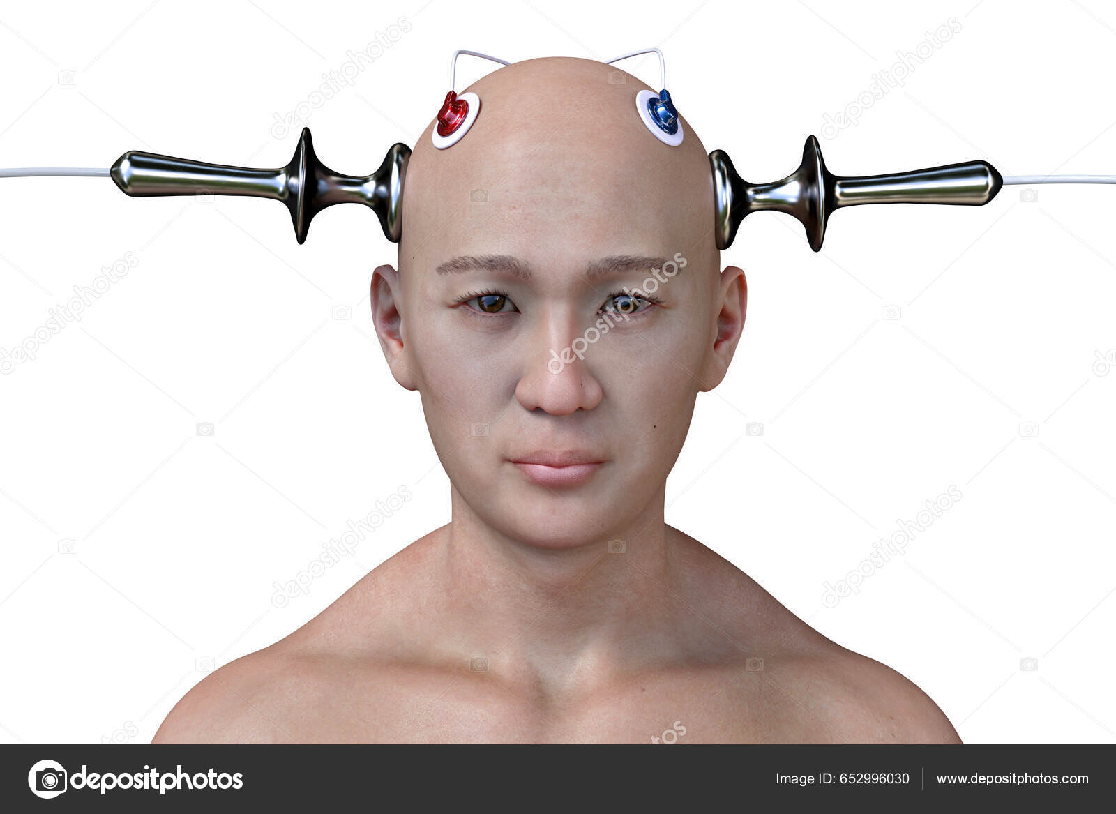 Electroconvulsive Therapy Ect Treatment Used Severe Mental Illnesses ...