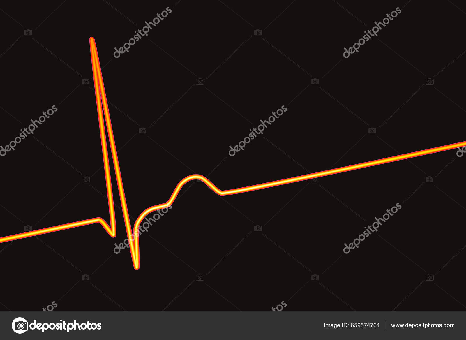 Electrocardiogram Ecg Displaying Junctional Rhythm Which Occurs ...