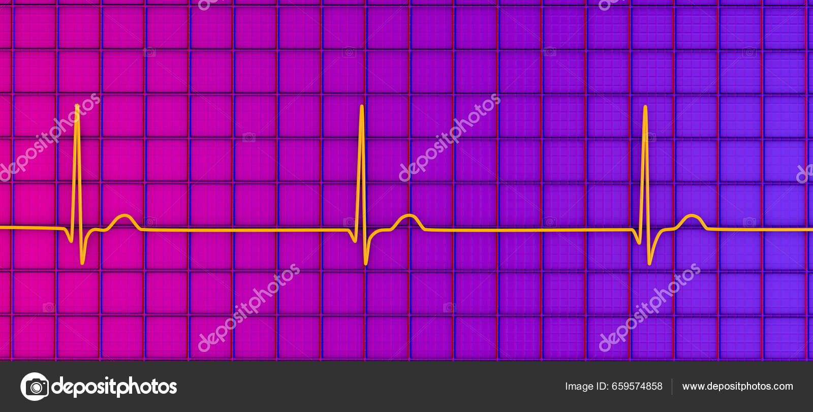 Electrocardiogram Ecg Displaying Junctional Rhythm Which Occurs ...