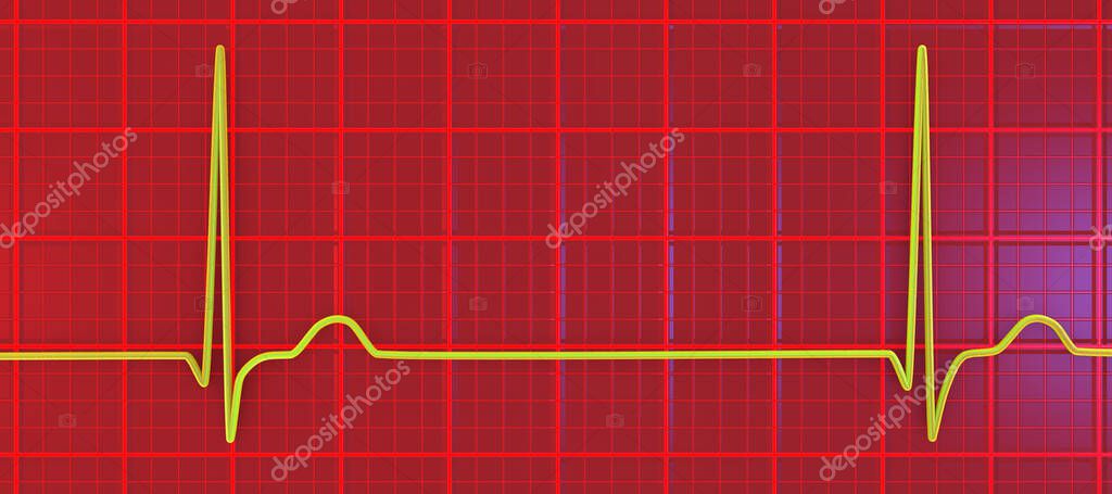 Electrocardiograma ECG que muestra un ritmo de unión, que ocurre cuando ...