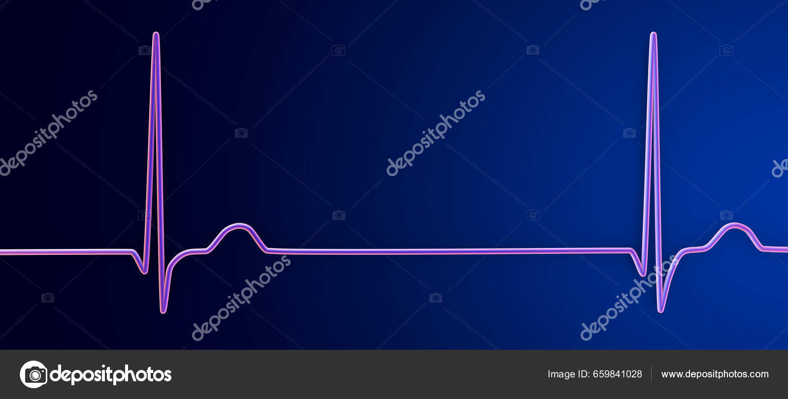 Electrocardiogram Ecg Displaying Junctional Rhythm Which Occurs ...