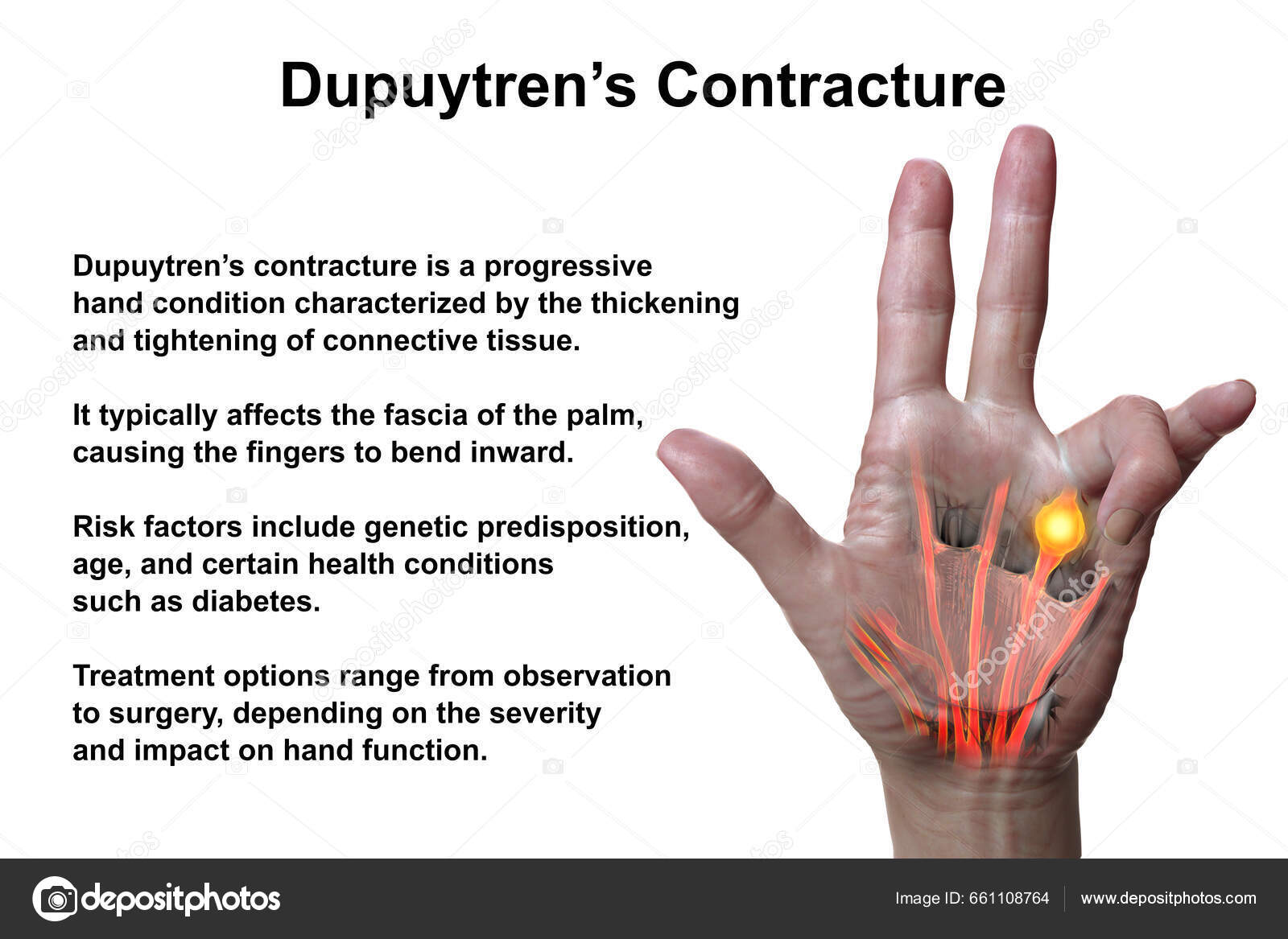 Medical Illustration Displaying Patient's Hand Dupuytren's Contracture ...