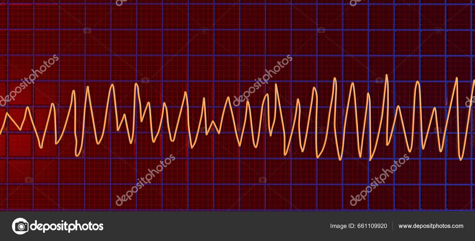 Ecg Displaying Torsades Pointes Rhythm Dangerous Heart Rhythm Fast ...