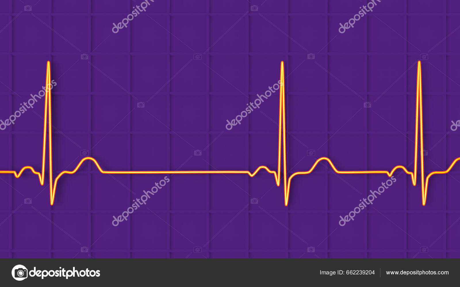 Una Ilustración Detallada Electrocardiograma Ecg Que Muestra Arritmia ...