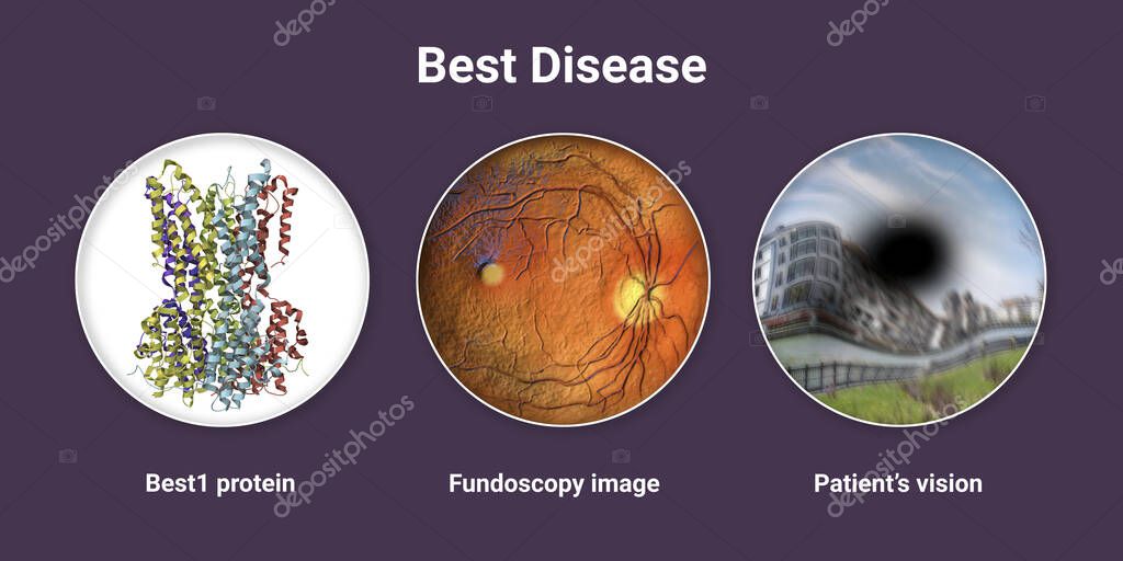La mejor enfermedad. La mejor distrofia macular vitelliforme ...