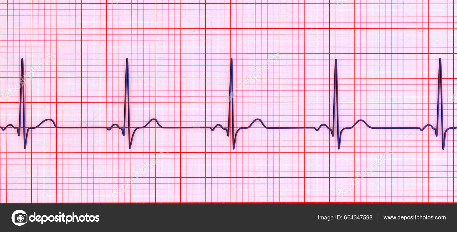 Normal Electrocardiogram Ecg Illustration Displaying Electrical ...