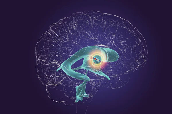 El foramen interventricular, el foramen de Monro, un paso que conecta ...