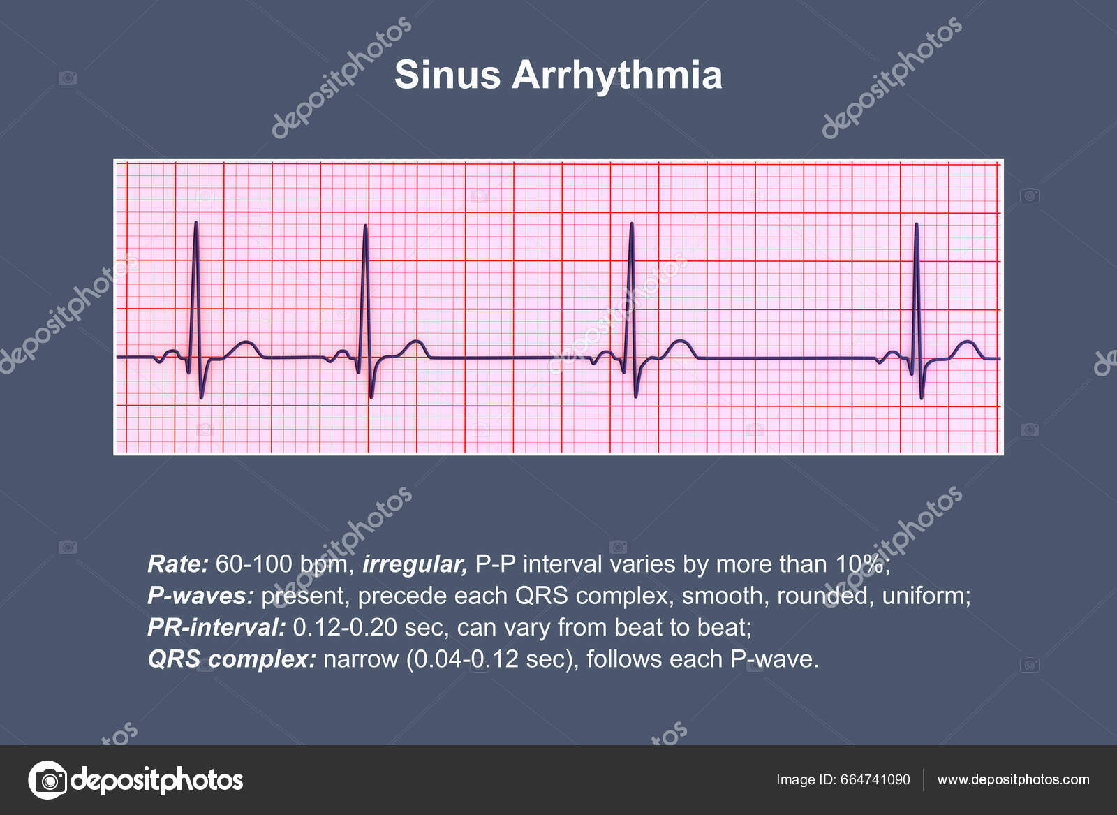 Uma Ilustração Detalhada Eletrocardiograma Ecg Que Mostra Arritmia ...