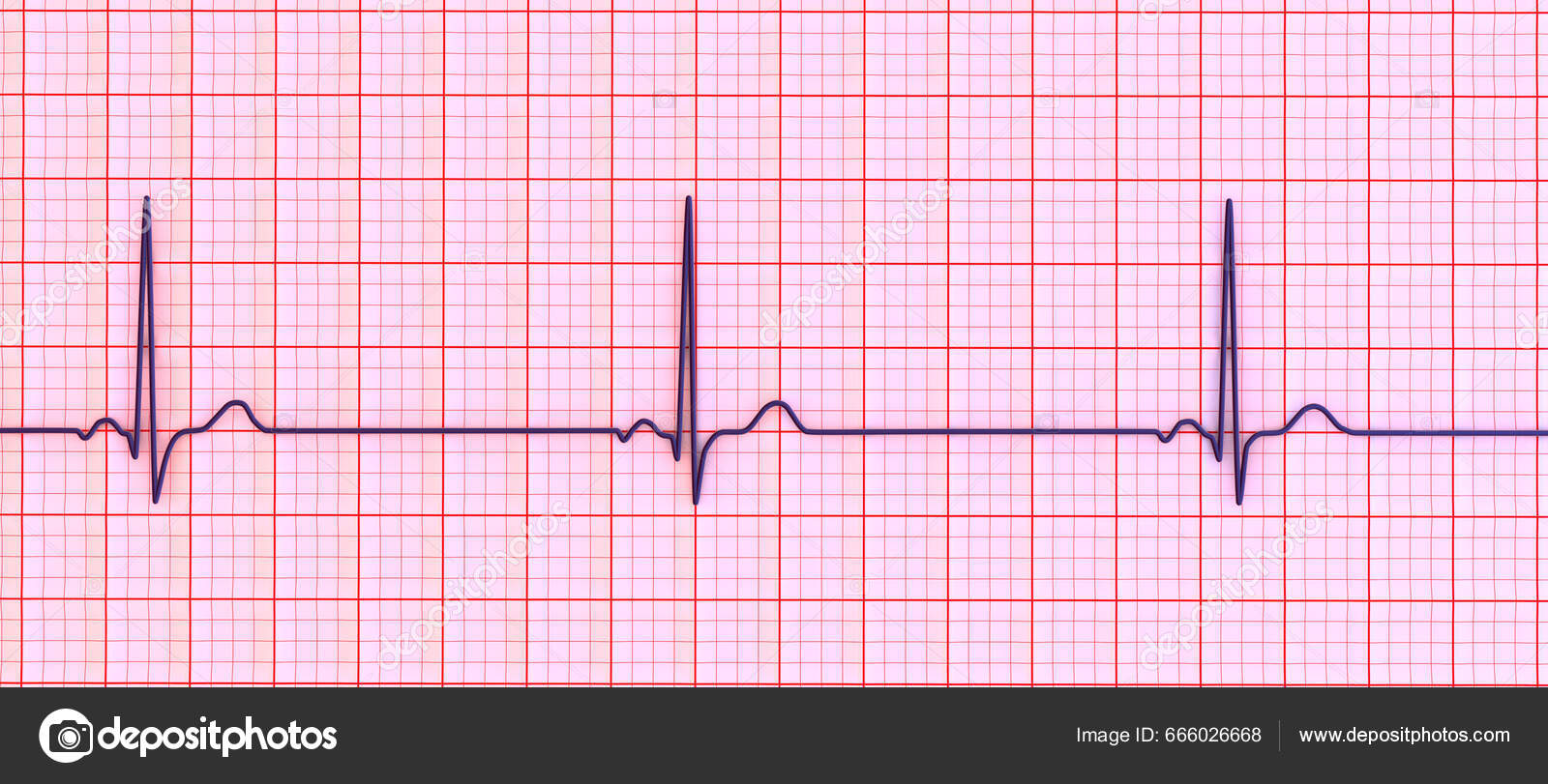 Detailed Illustration Electrocardiogram Displaying Sinus Bradycardia ...