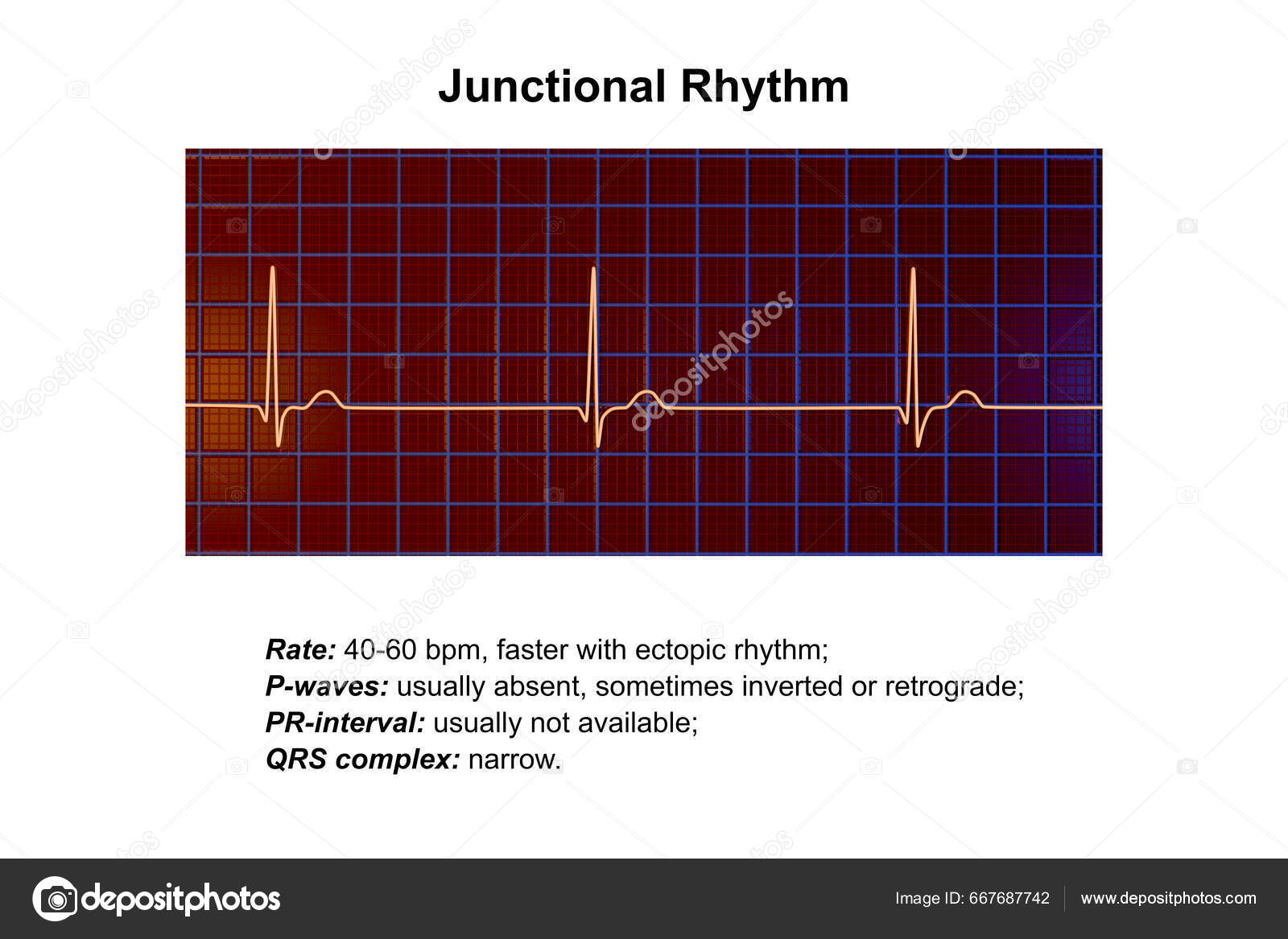 Junctional Tachycardia
