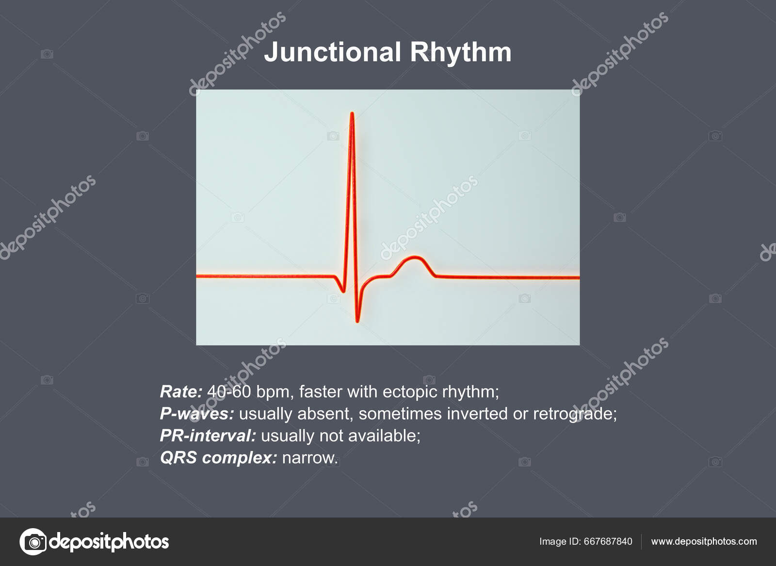 Junctional Rhythm Inverted P Wave