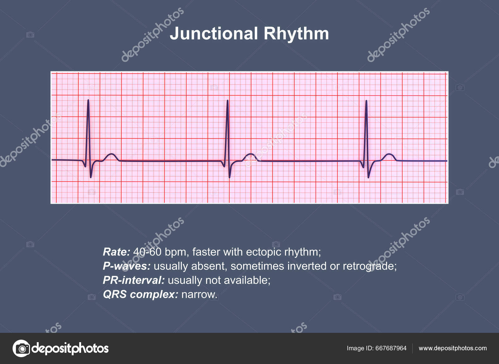 Junctional Tachycardia EKGDX The New Era Of EKG Learning