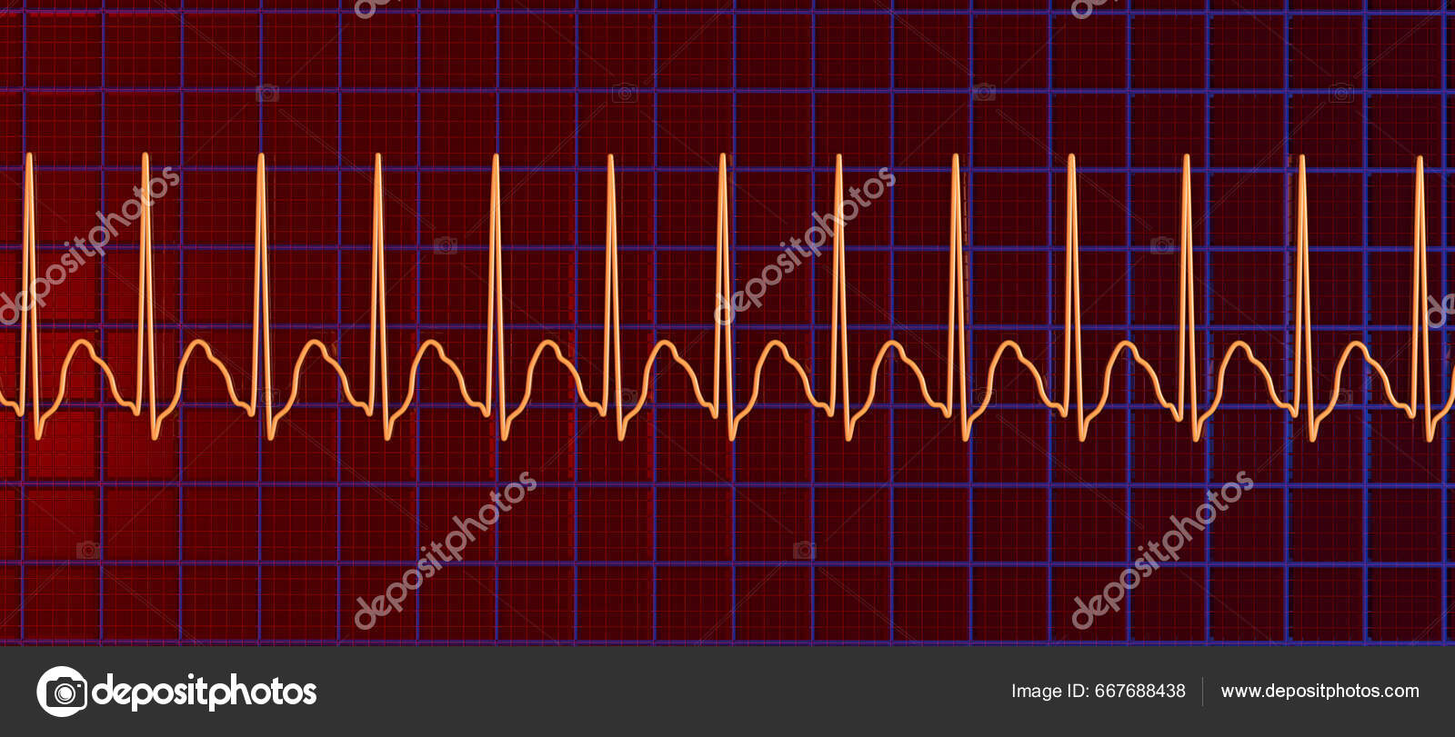 Ecg Taquicardia Supraventricular Con