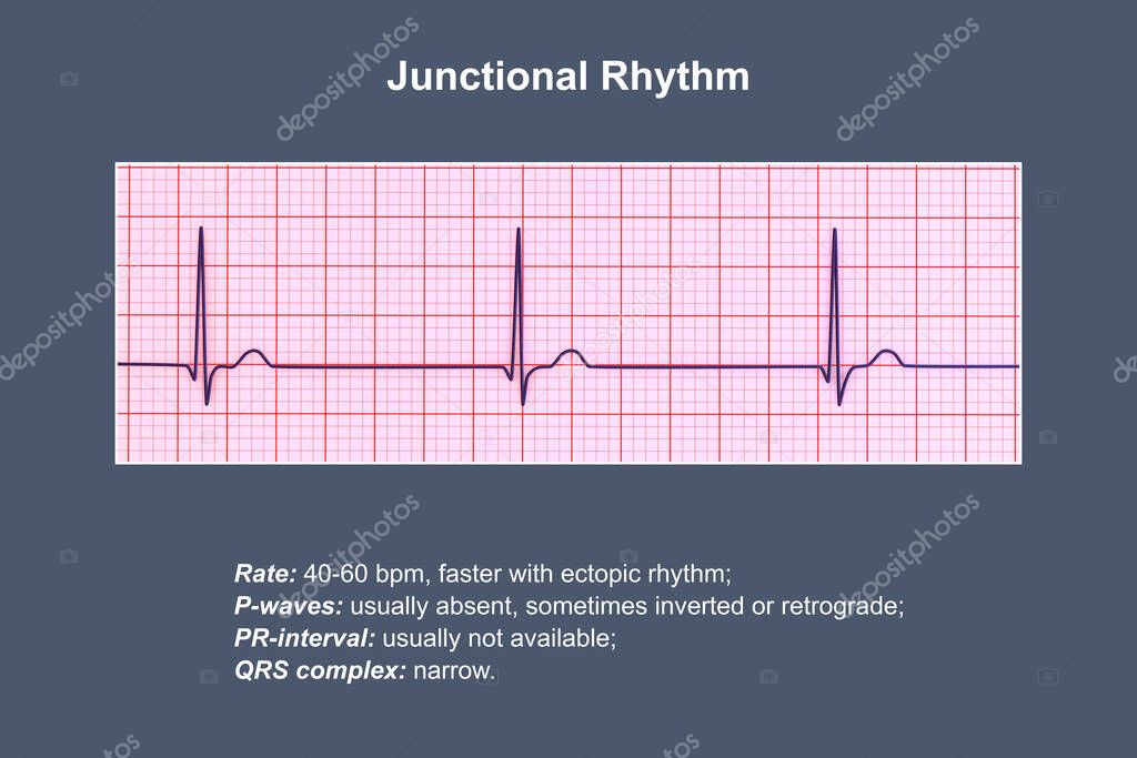 Electrocardiograma que muestra un ritmo de unión, que ocurre cuando las ...