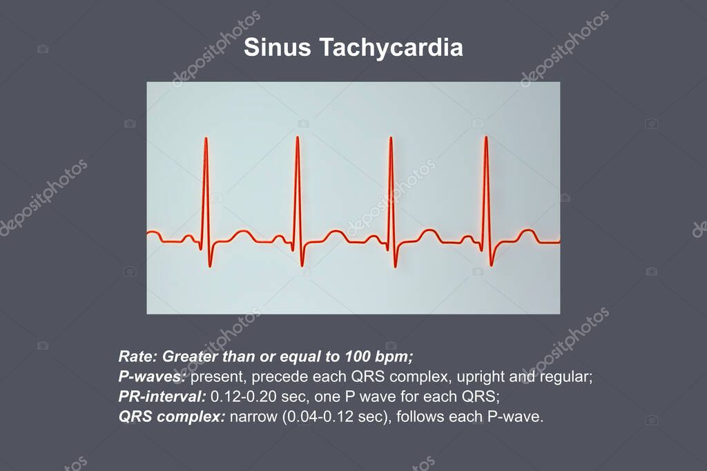 Electrocardiograma (ECG) que muestra taquicardia sinusal, un ritmo ...