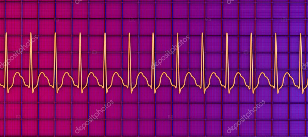 Taquicardia Supraventricular De Ecg
