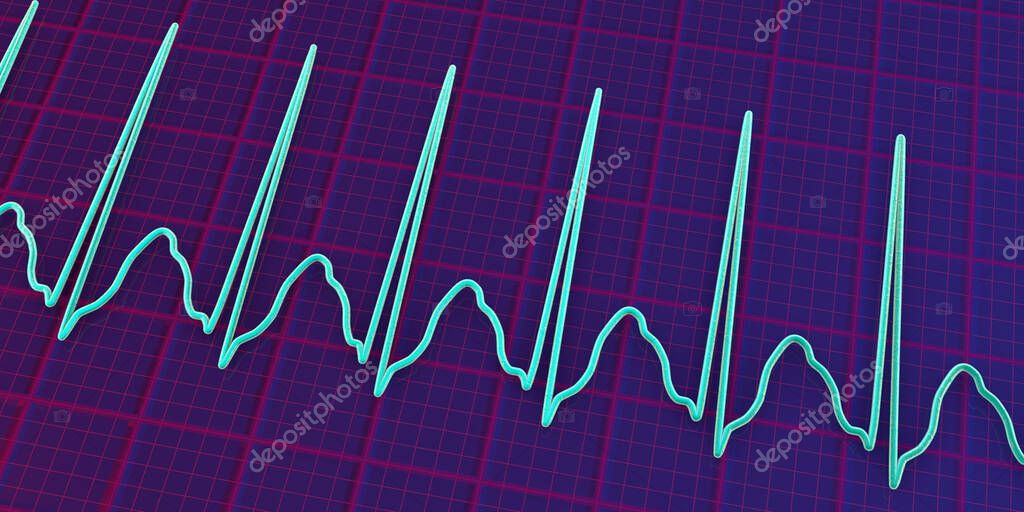 ECG en taquicardia supraventricular, una frecuencia cardíaca rápida que se origina por encima de ...