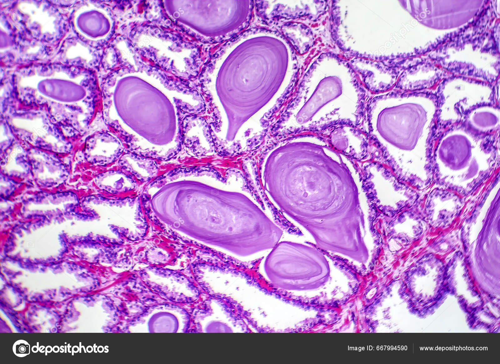 Micrograph Prostatic Hyperplasia Showing Increased Glandular Tissue ...