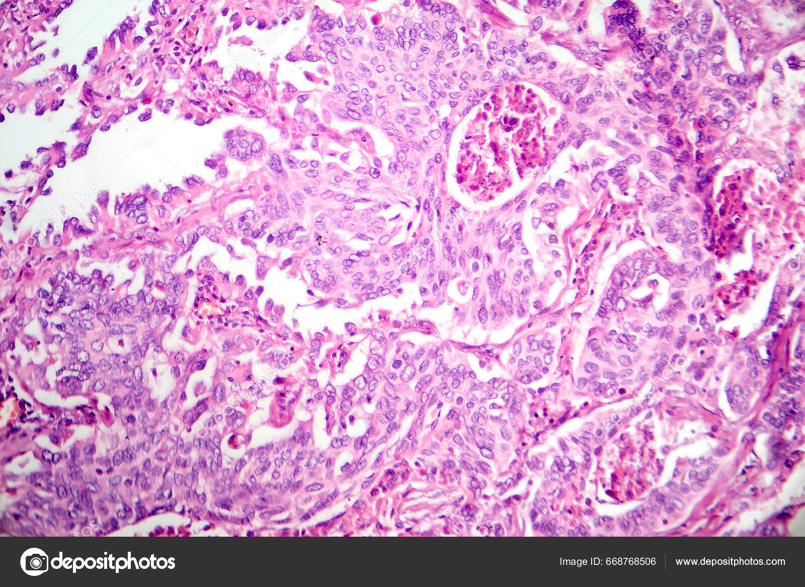 Photomicrograph Lung Adenocarcinoma Illustrating Malignant Glandular ... Photomicrograph Lung Adenocarcinoma Illustrating Malignant Glandular ...