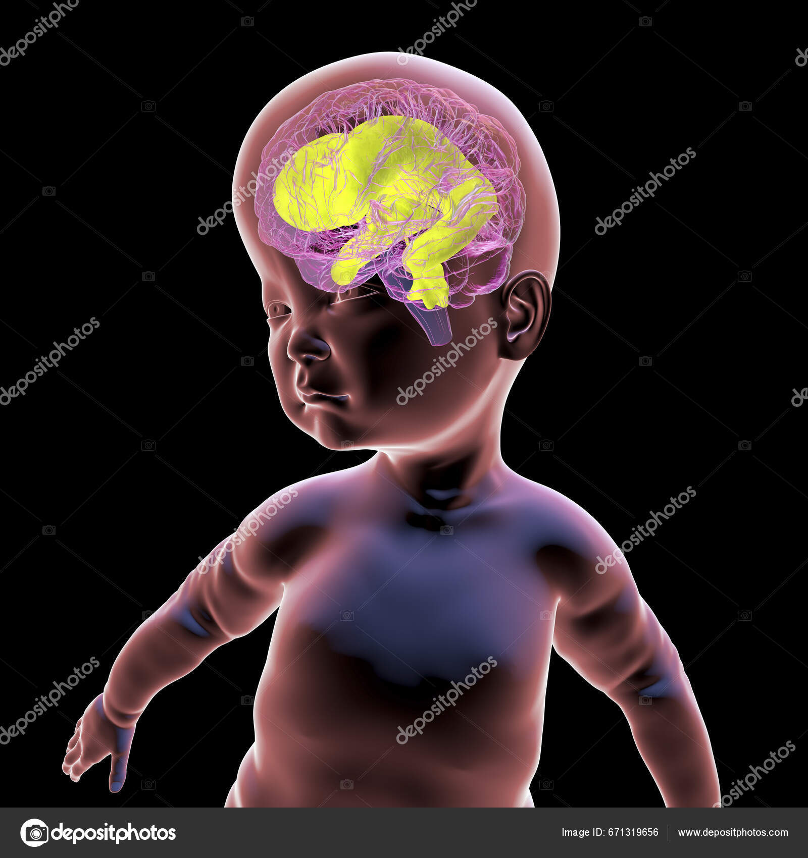 Macrocephaly In Infants