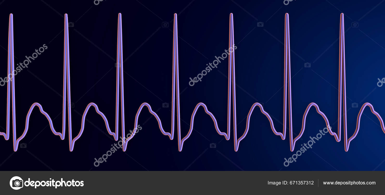 Ecg Taquicardia Supraventricular Una Frecuencia Cardíaca Rápida Que Origina Por — Foto de stock ...