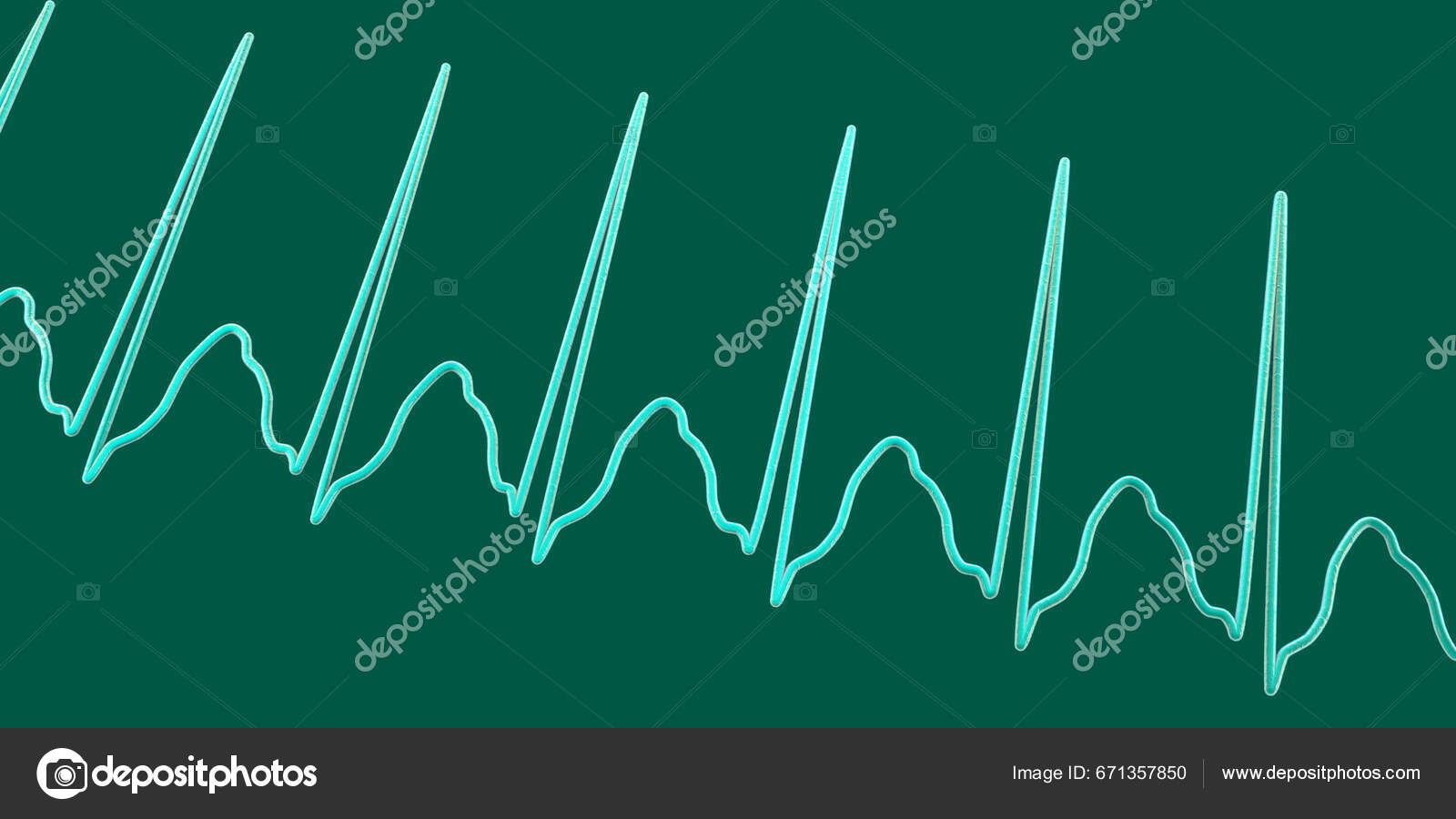 Ecg Taquicardia Supraventricular Una Frecuencia Cardíaca Rápida Que Origina Por: fotografía de ...