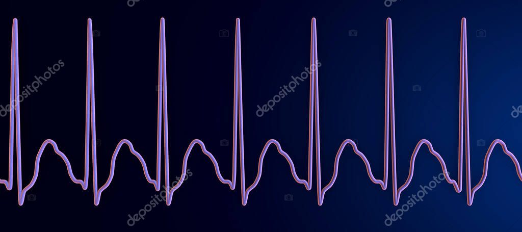 ECG en taquicardia supraventricular, una frecuencia cardíaca rápida que se origina por encima de ...