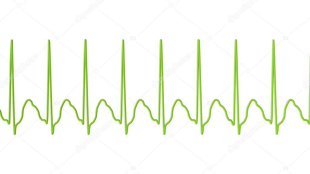 ECG en taquicardia supraventricular, una frecuencia cardíaca rápida que se origina por encima de ...